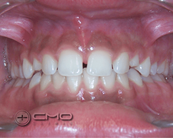 Caninos Inclusos (Ortodontia) - Caso 4 - CMO Clinic
